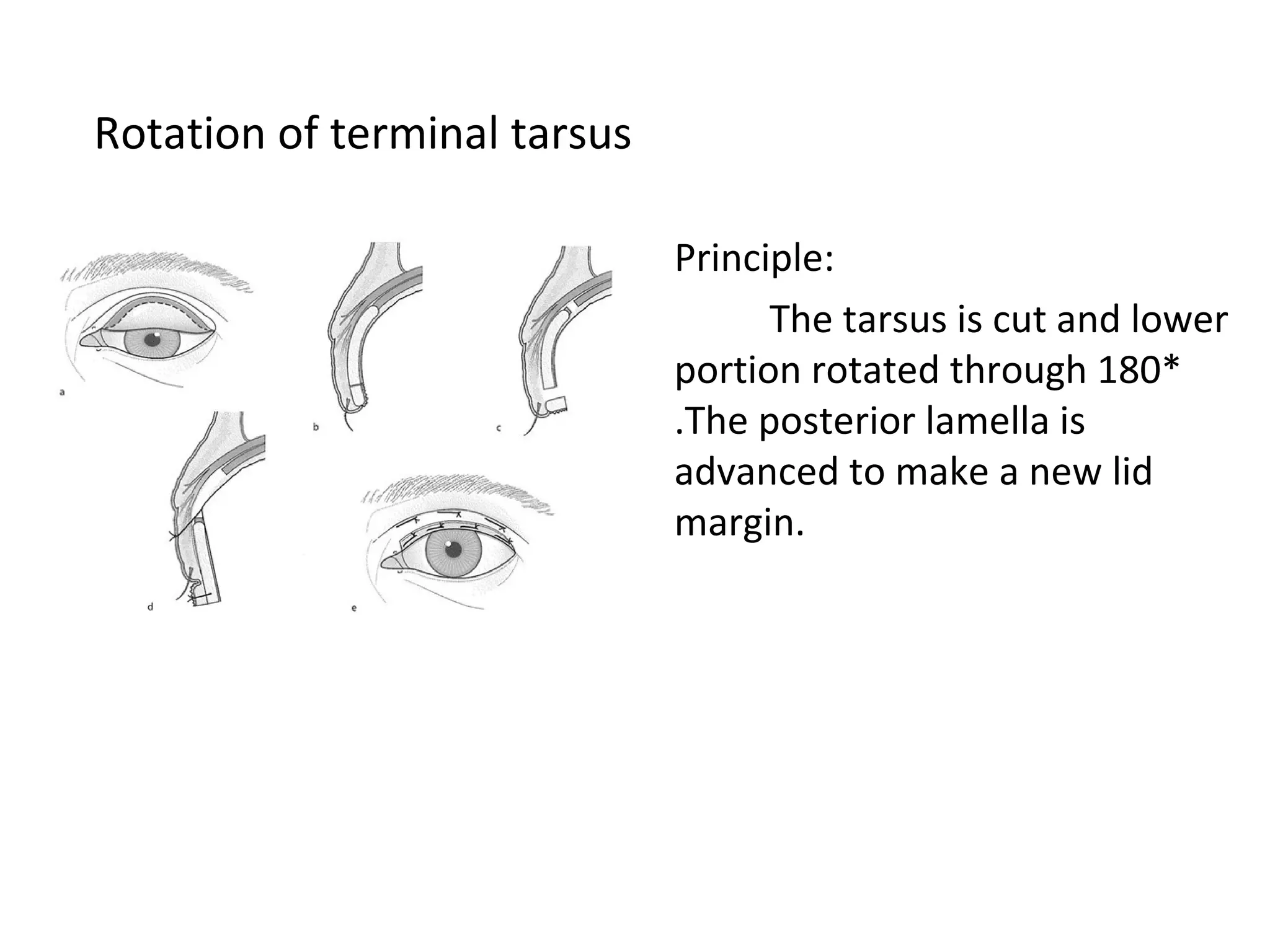Entropion and its surgical correction | PPT
