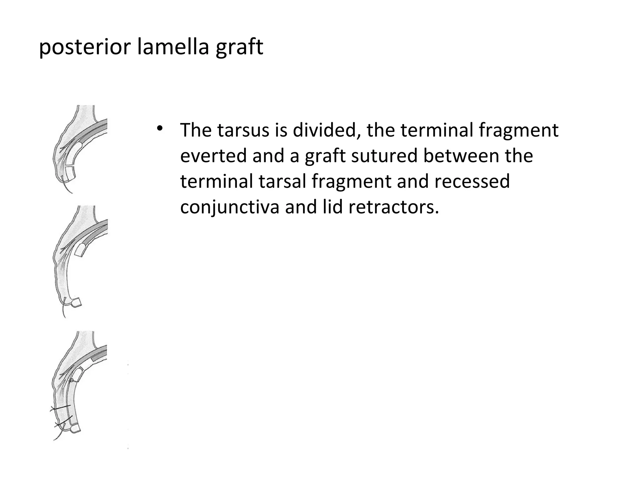 Entropion and its surgical correction | PPT