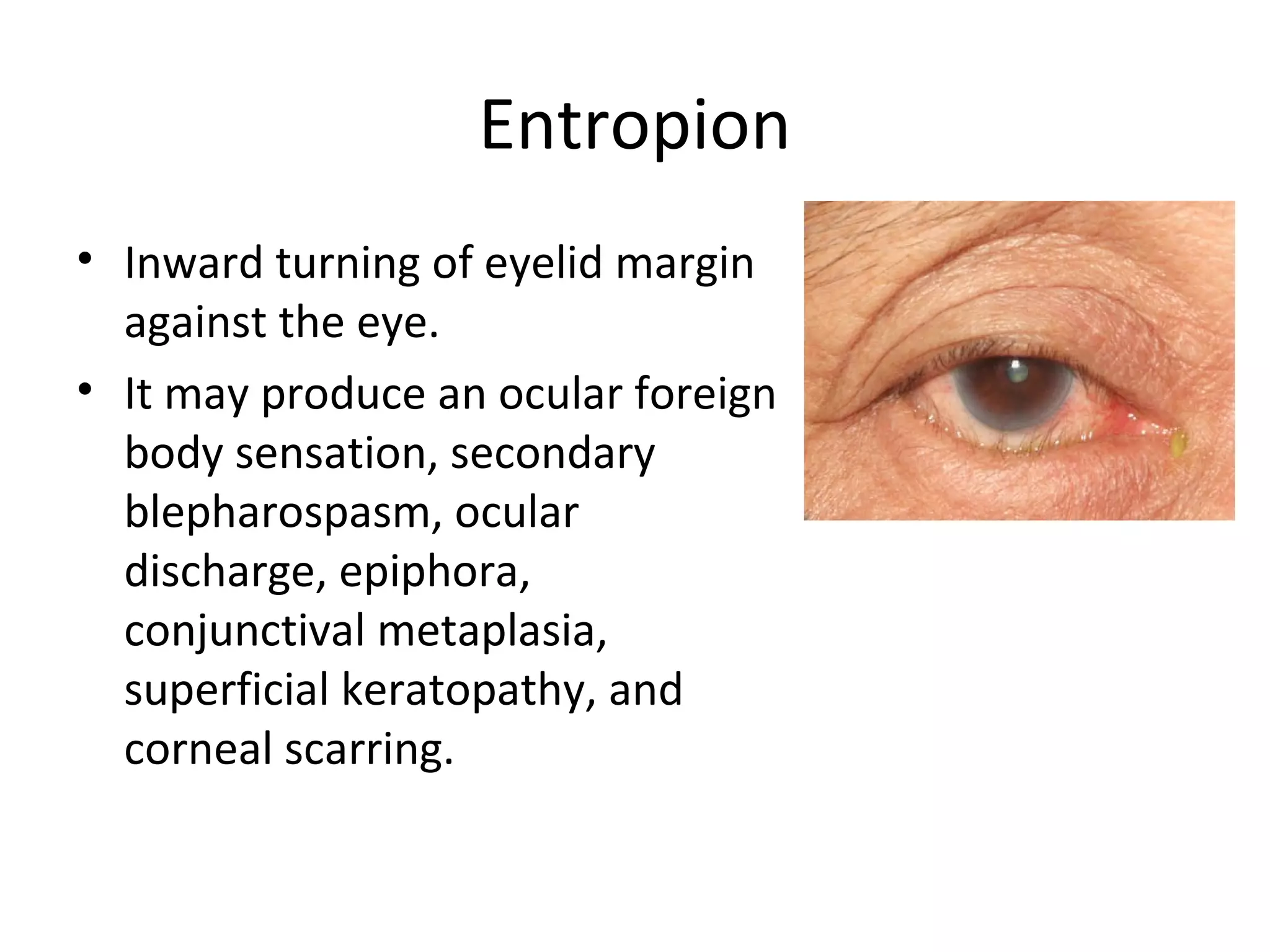 Entropion and its surgical correction | PPT