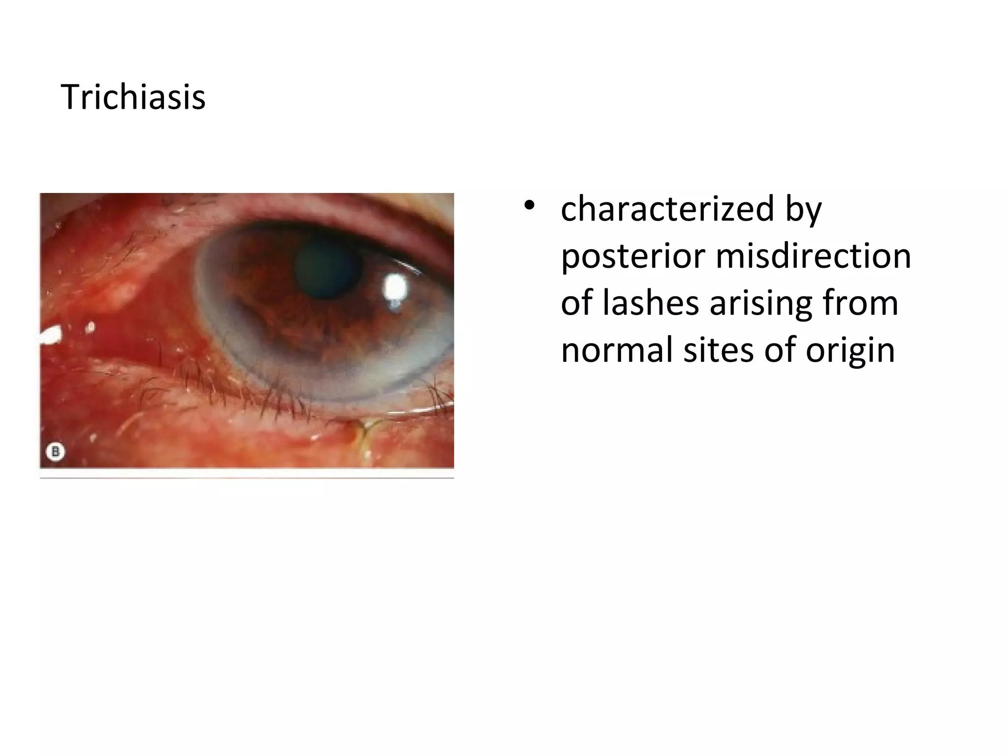 Entropion and its surgical correction | PPT