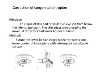Entropion and its surgical correction | PPT