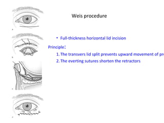 Entropion and its surgical correction | PPT