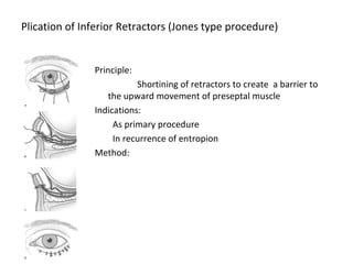 Entropion and its surgical correction | PPT