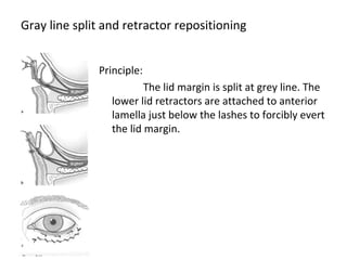 Entropion and its surgical correction | PPT