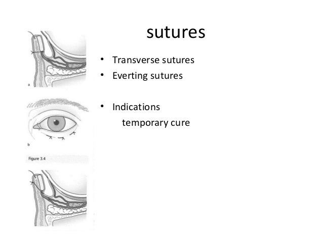 Entropion and its surgical correction