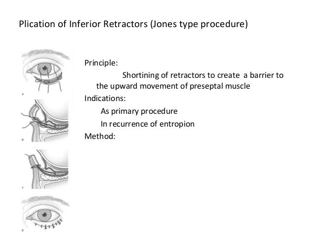 Entropion and its surgical correction