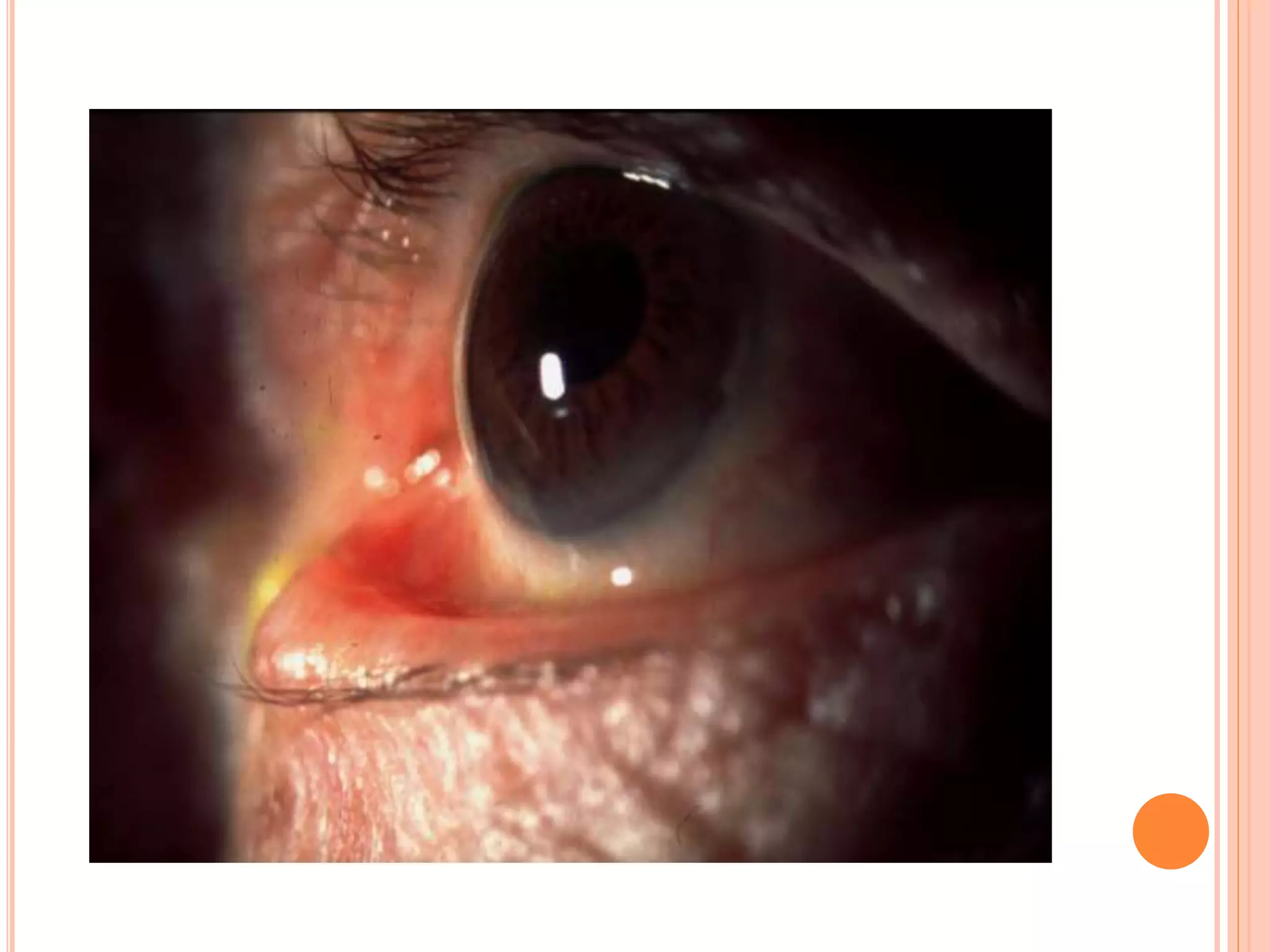 Ectropion and entropion | PPTX