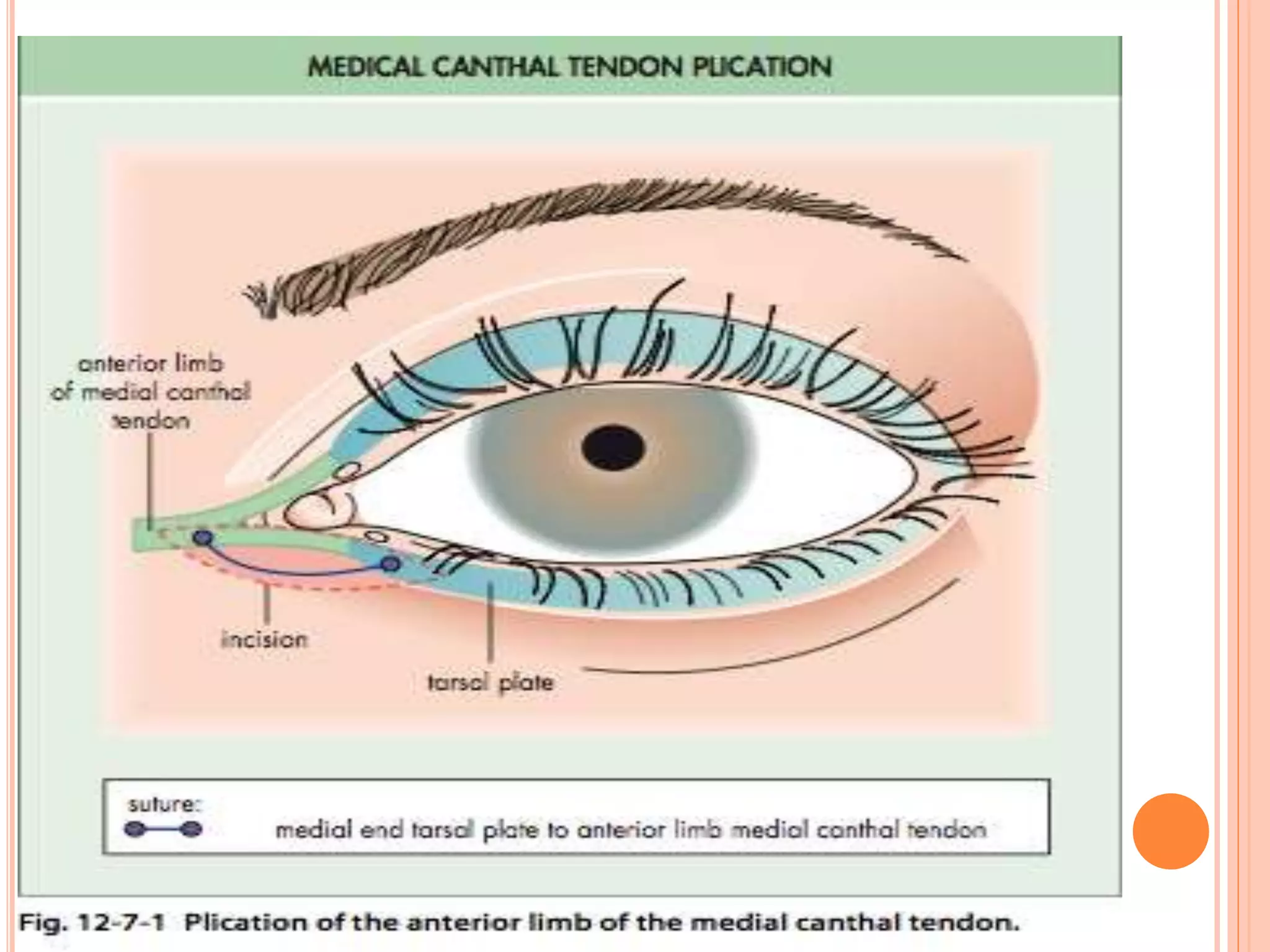 Ectropion and entropion | PPTX