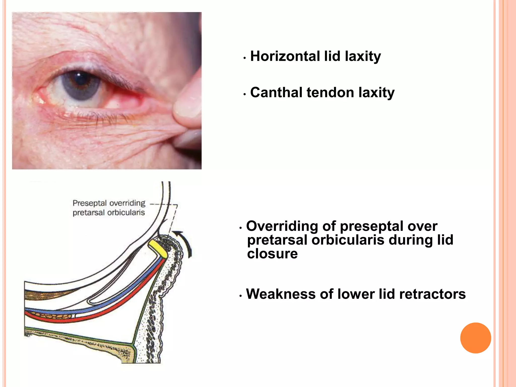 Ectropion and entropion | PPTX