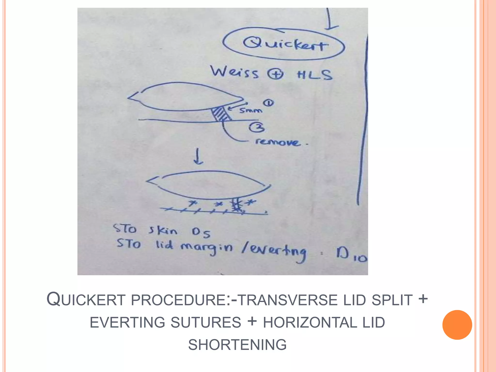 Ectropion and entropion | PPTX