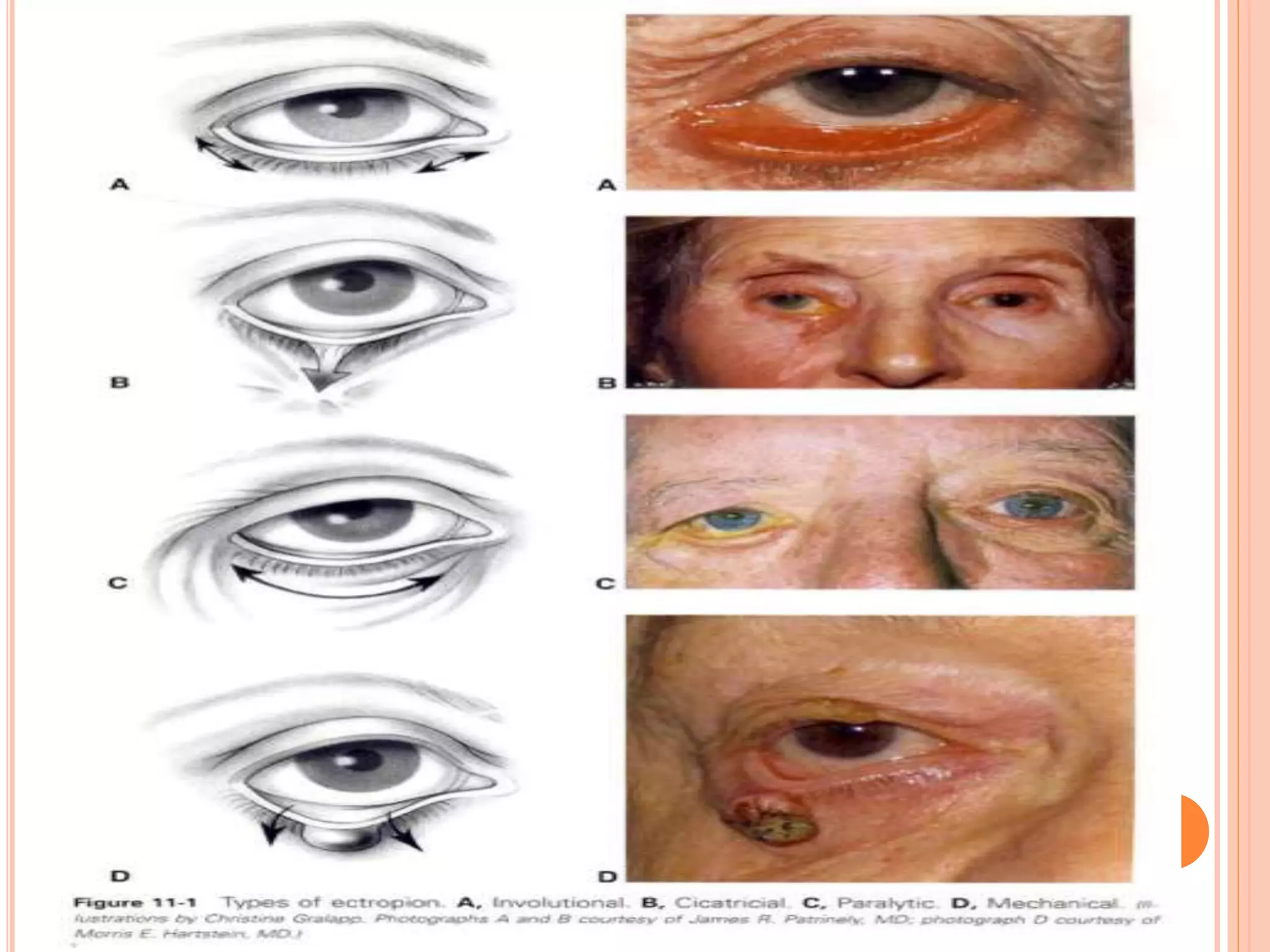 Ectropion and entropion | PPTX
