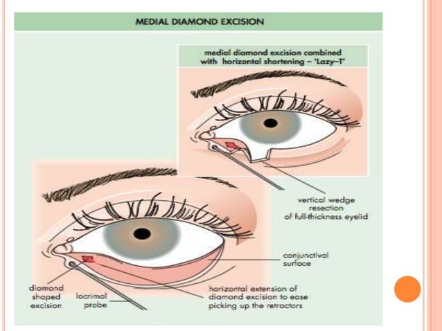 Ectropion and entropion | PPTX | Eye and Vision Conditions | Diseases and Conditions