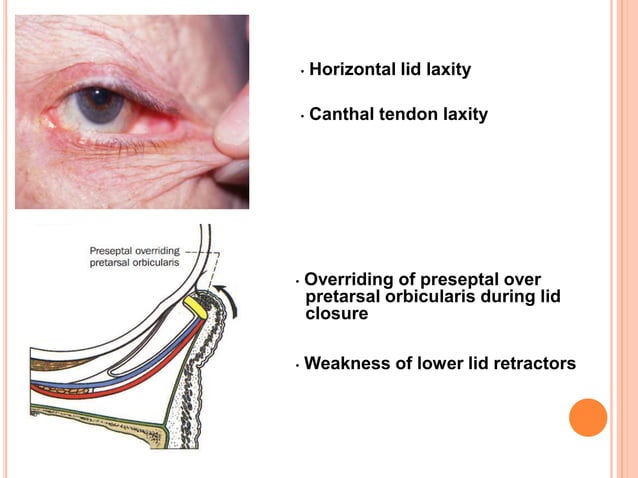 Ectropion and entropion | PPTX | Eye and Vision Conditions | Diseases ...