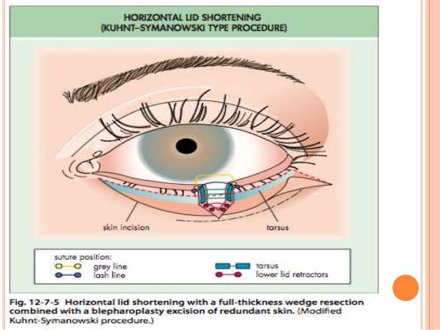 Ectropion and entropion