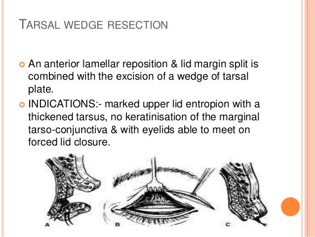 Ectropion and entropion