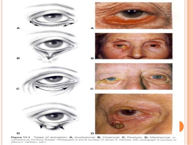 Ectropion and entropion