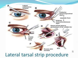 Ectropion and Entropion.pptx