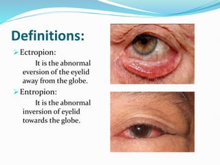 Ectropion and Entropion.pptx