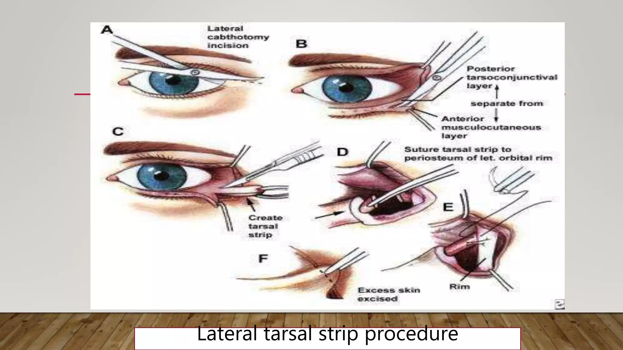 Ectropion | PPTX