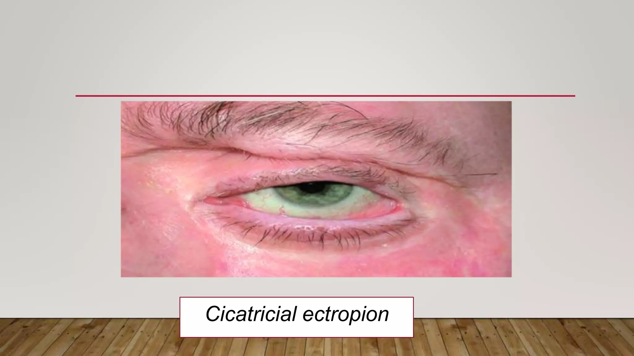 Ectropion | PPTX