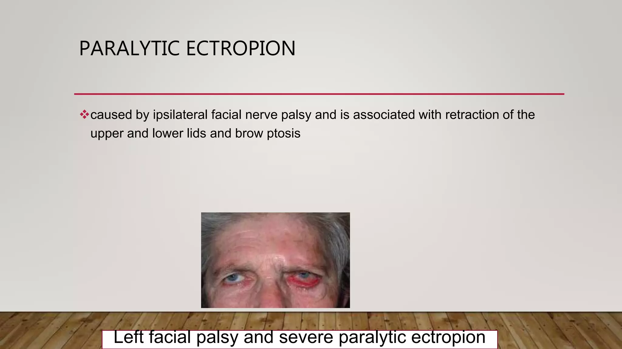 Ectropion | PPTX