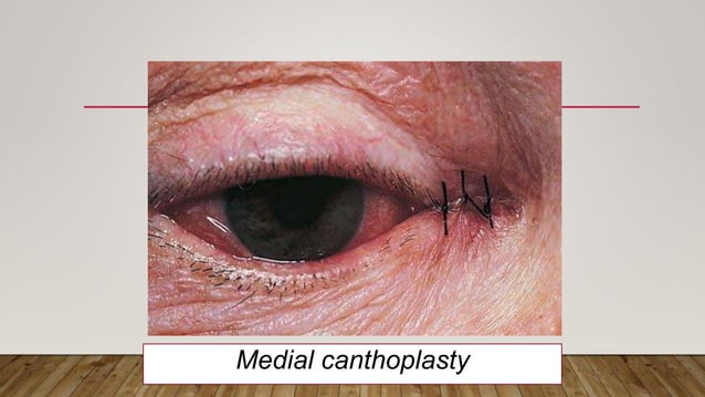 Ectropion | PPT