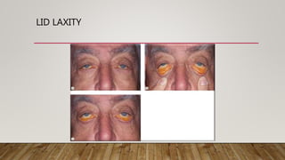 Ectropion | PPTX