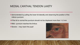 Ectropion | PPTX