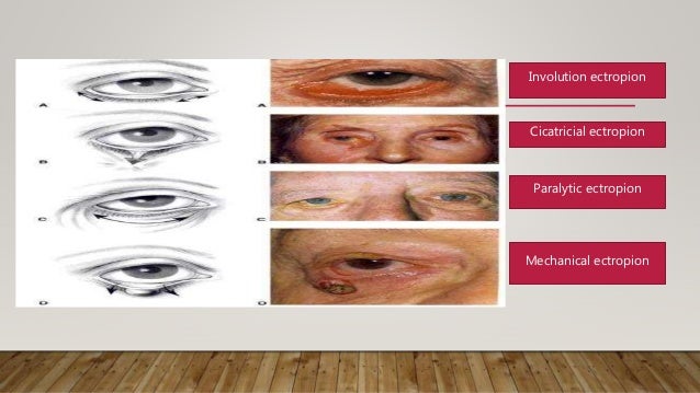 Ectropion
