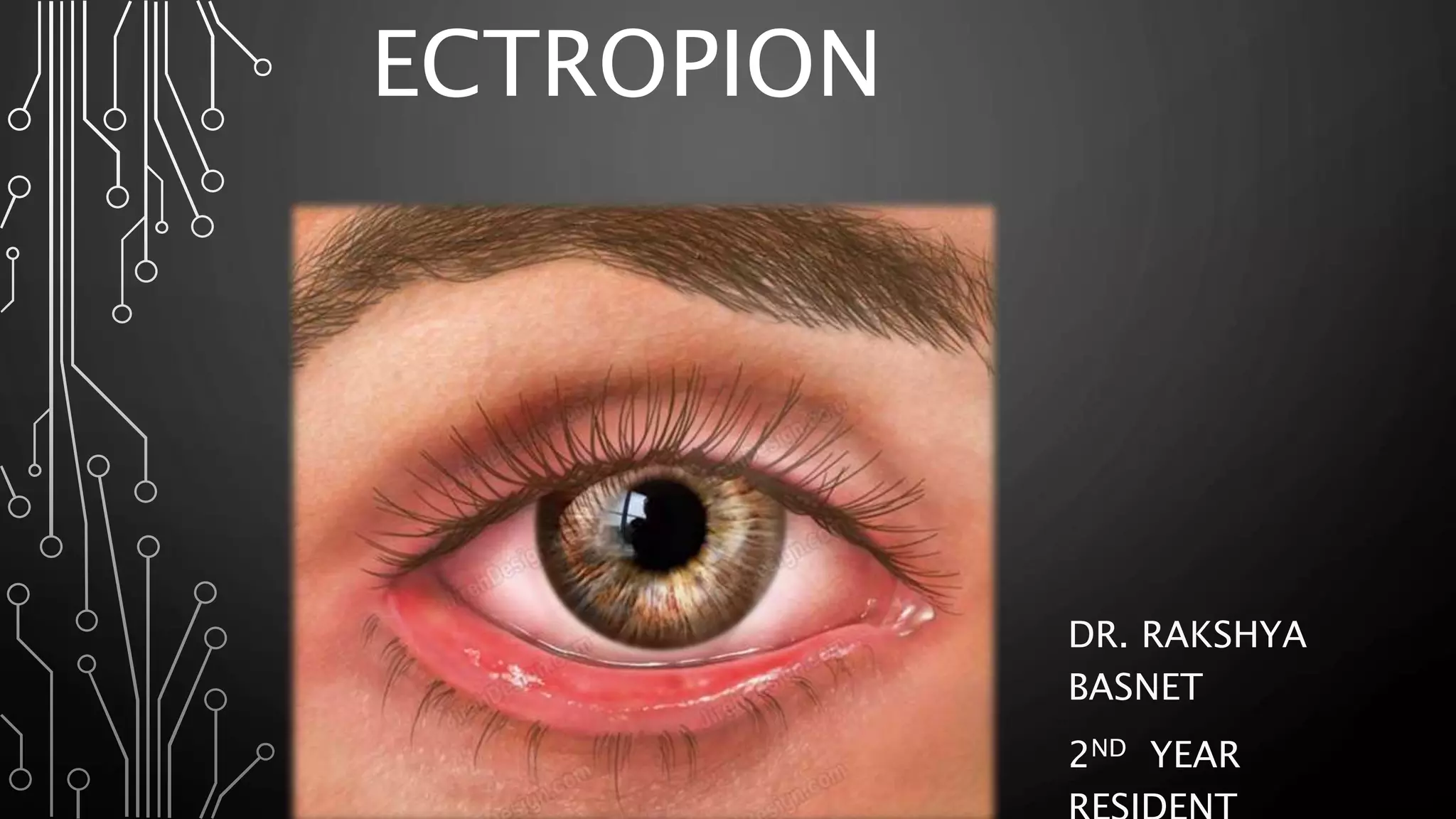 Ectropion | PPTX