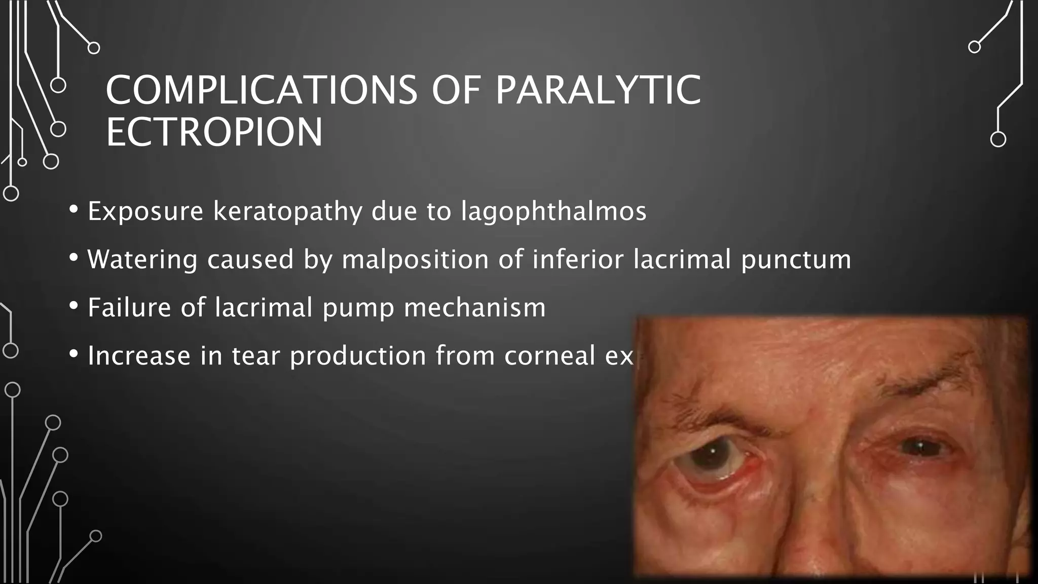 Ectropion | PPTX