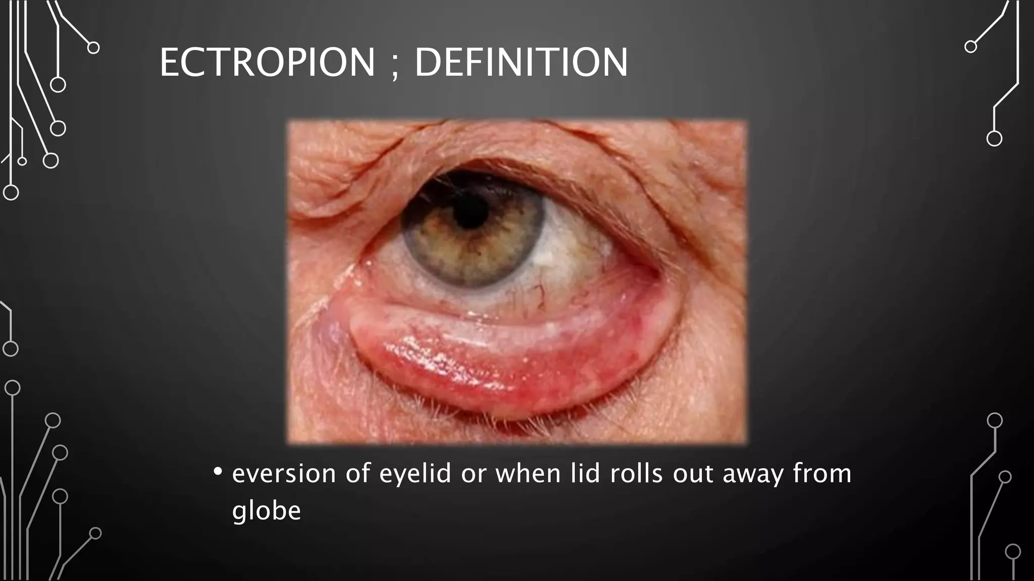 Ectropion | PPTX