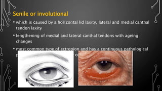 Ectropion | PPTX