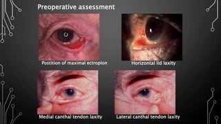 Ectropion | PPTX