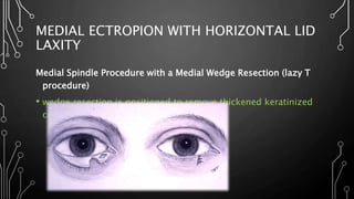 Ectropion | PPTX