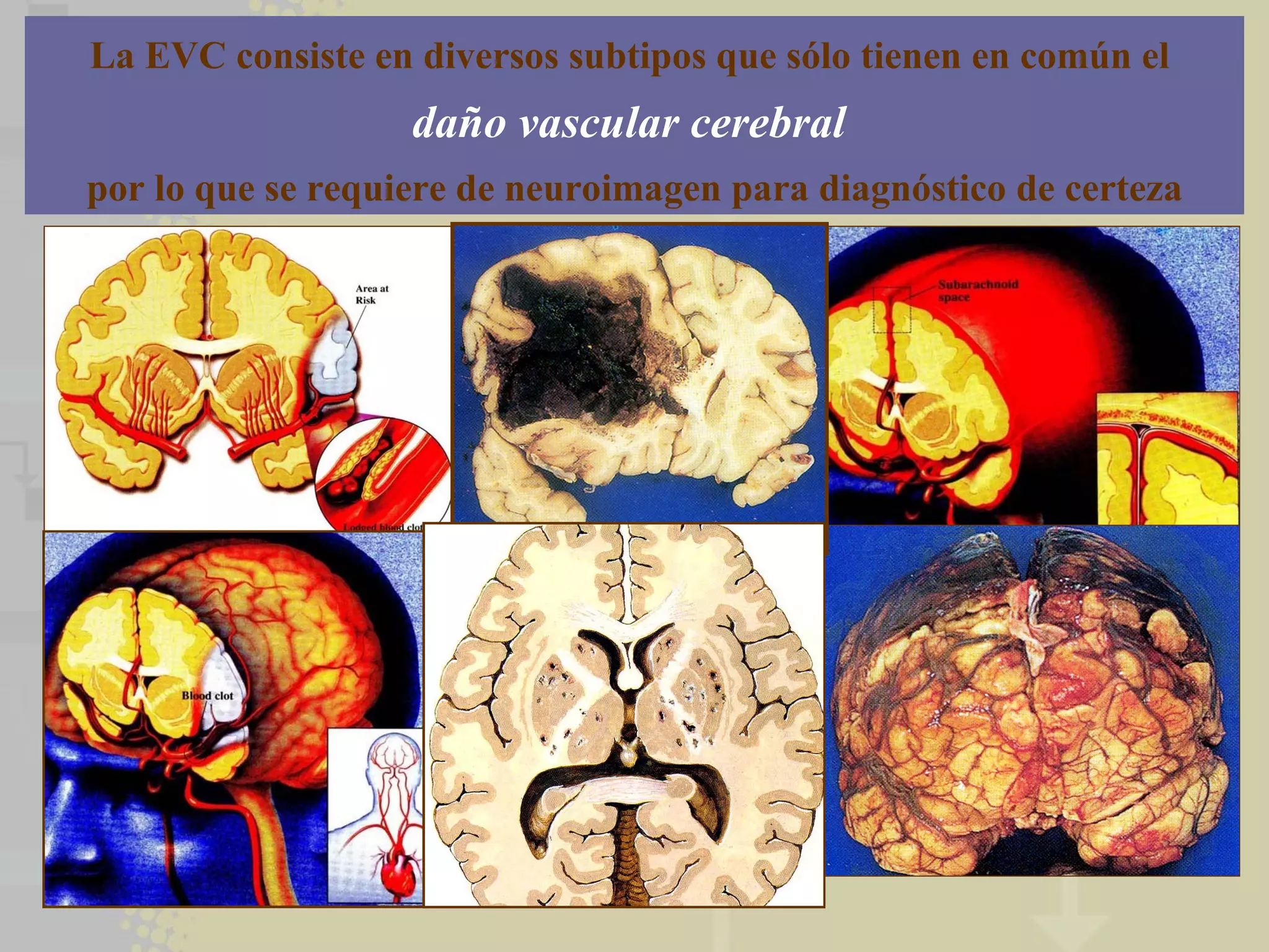 Imagen Isquemia Cerebrovascular DZ | PPS