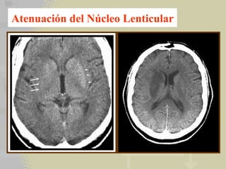 Imagen Isquemia Cerebrovascular DZ | PPS