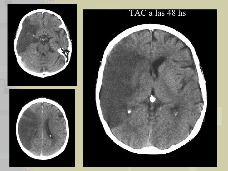 Imagen Isquemia Cerebrovascular DZ