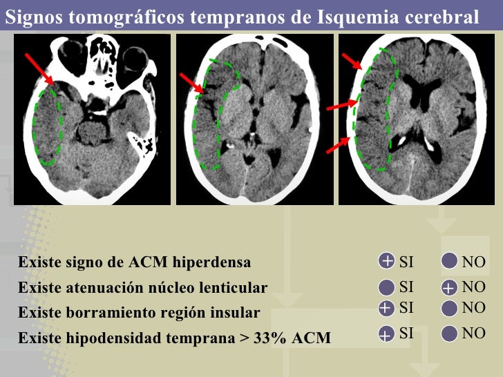Imagen Isquemia Cerebrovascular DZ