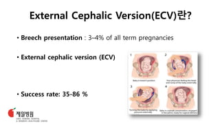 ECV 역아회전술- 한정열 단국대 의대 교수 | PPT
