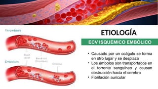 ECV, evento cerebro vascular .eliza.pptx