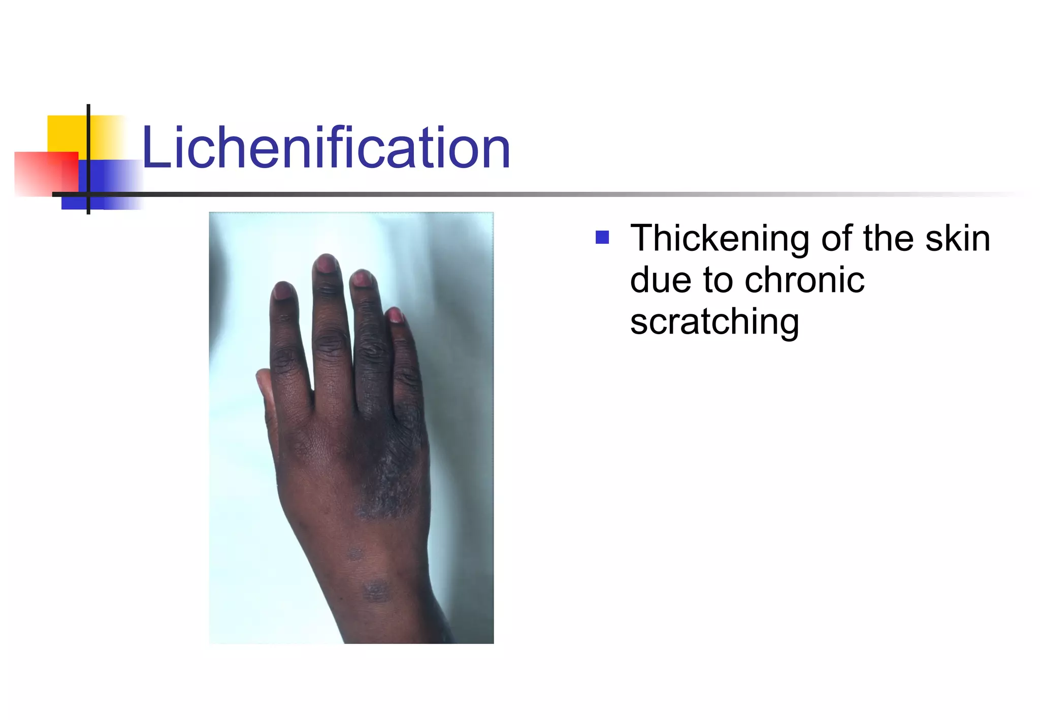 Eczema | PPT