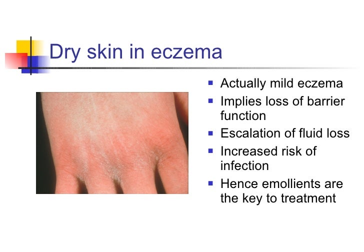 Eczema