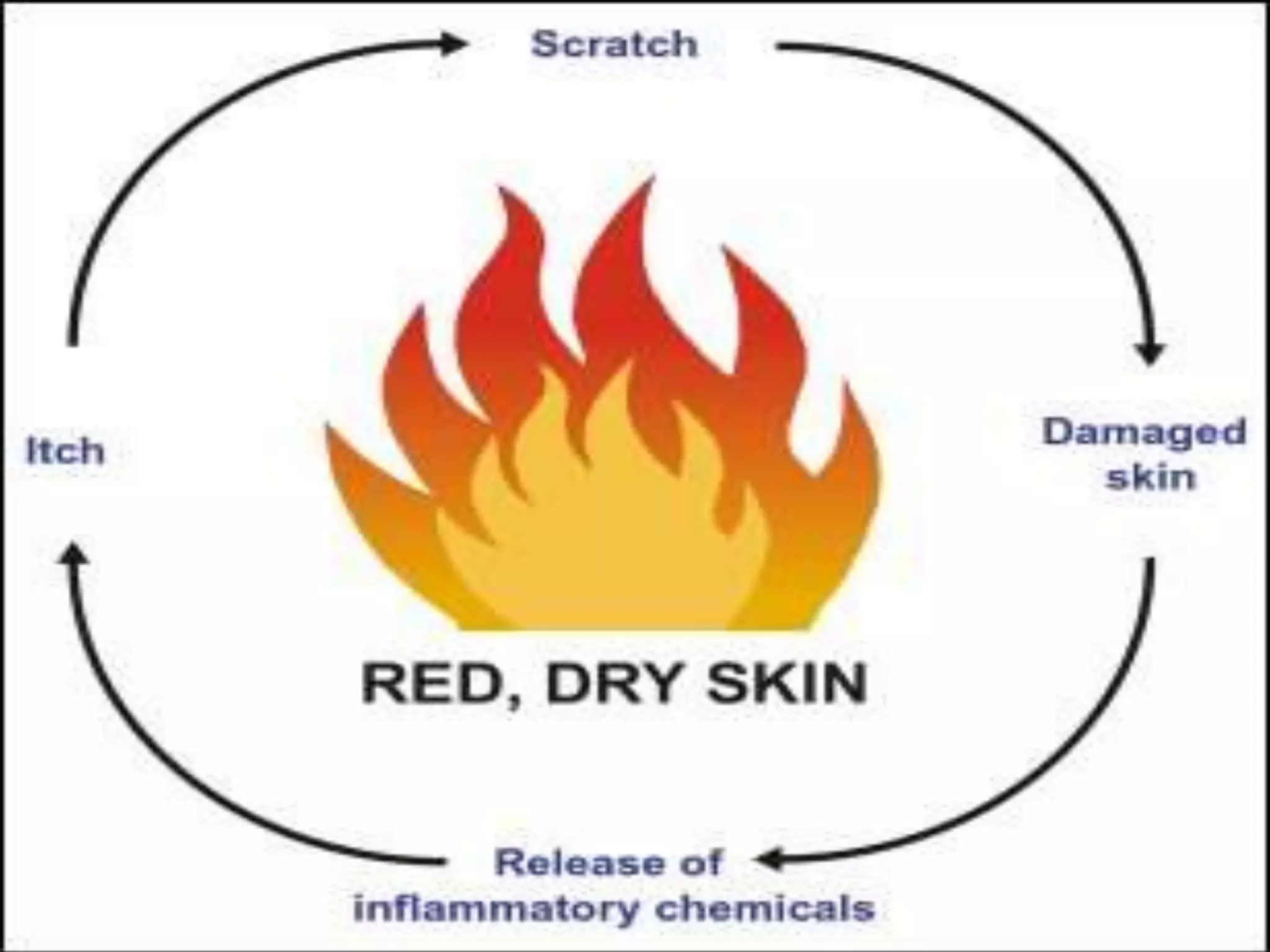 Eczema- A Chronic Skin Disease | PPTX