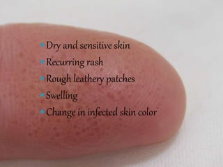 Eczema- A Chronic Skin Disease | PPTX