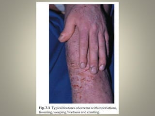 Excoriation Eczema