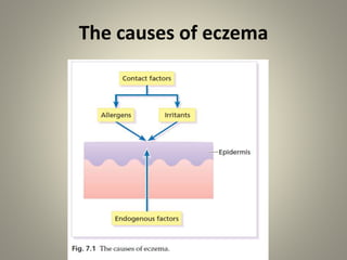 Eczema Charts