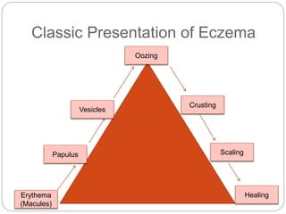 Eczema - A Case Presentation (by Dr. Julius King Kwedhi) | PPTX