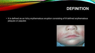 eczema complete information including treatment | PPTX