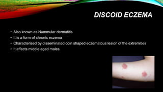 eczema complete information including treatment | PPTX